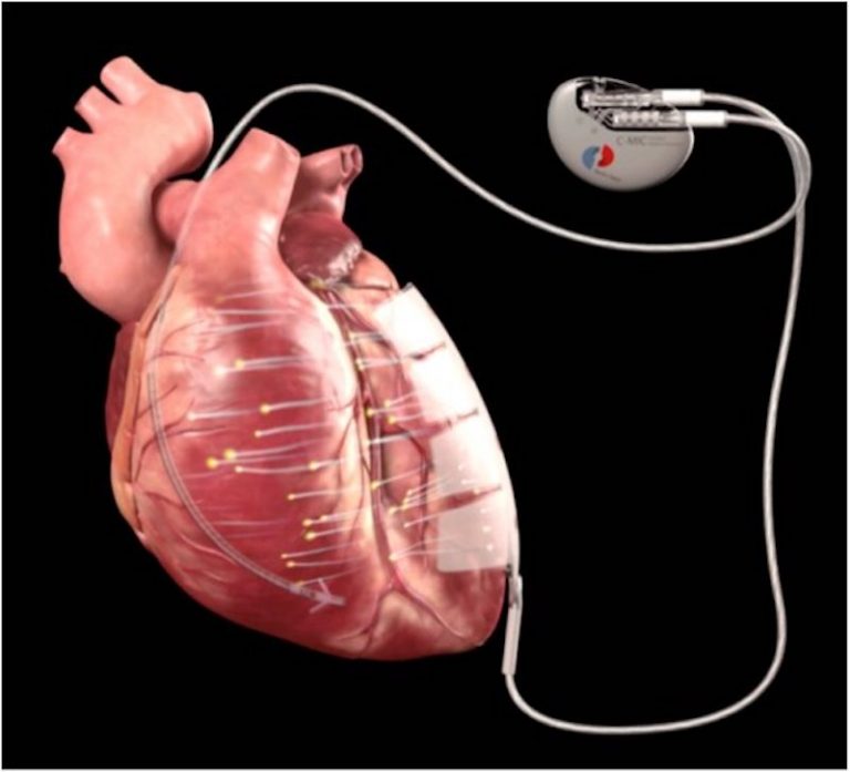 This new device can help exercise heart muscle