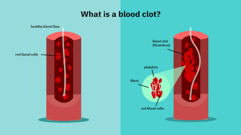 Blood clots: 10 things you need to know