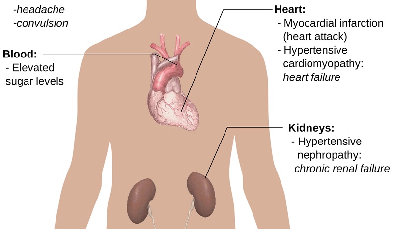 Sound waves could effectively break up kidney stones