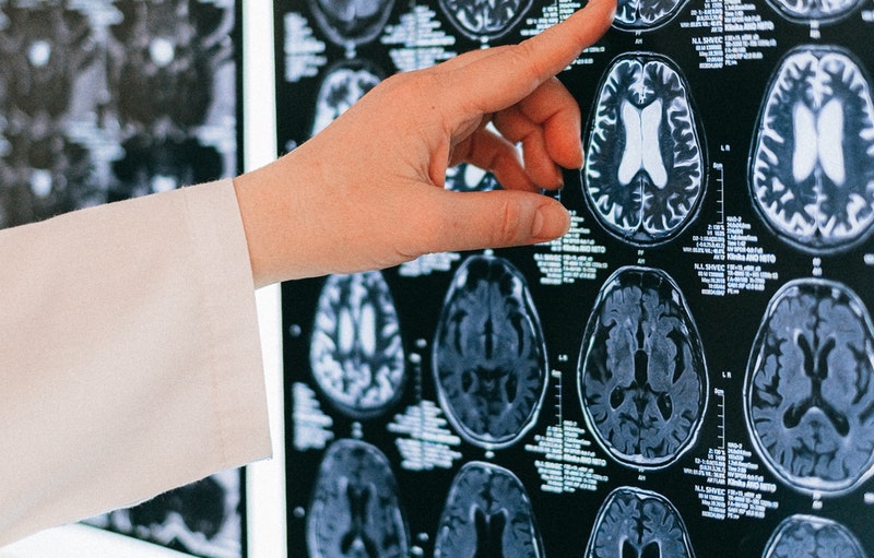 The chemical imbalance theory of depression is dead, but that doesn’t ...